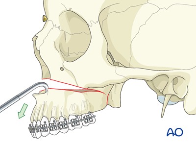 Le Fort I osteotomy for Maxillary prognathism