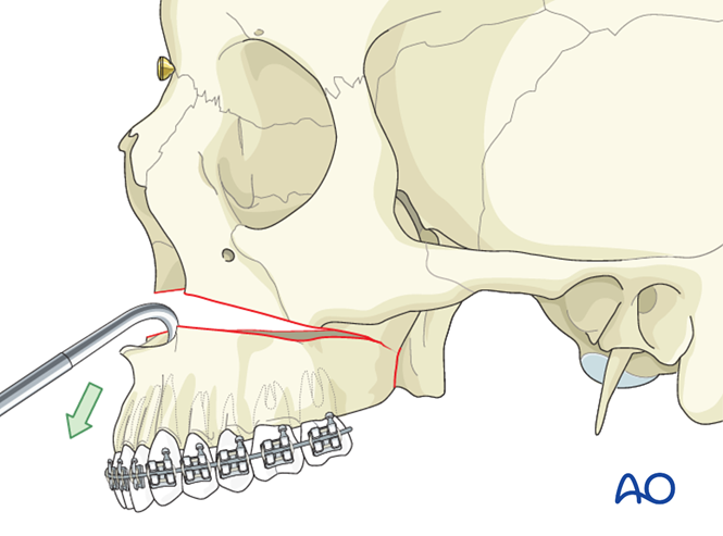 Le Fort I osteotomy for Maxillary retrognathism