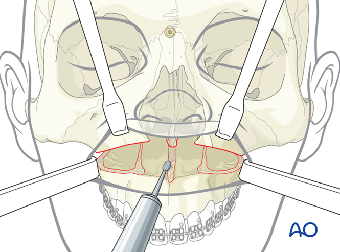 Le Fort I osteotomy for Maxillary prognathism