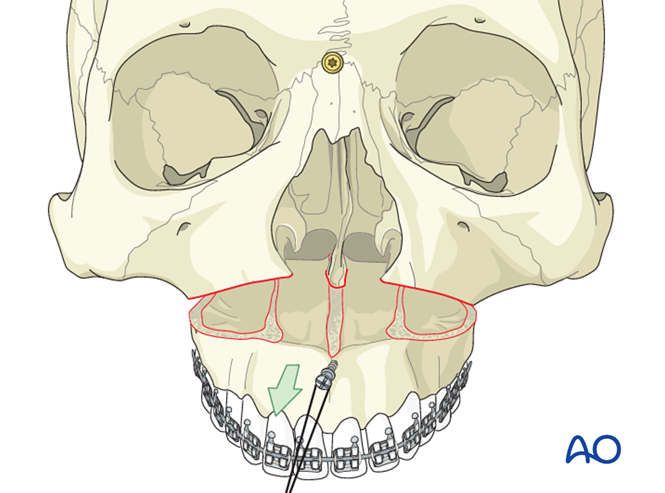 Le Fort I osteotomy for Maxillary retrognathism