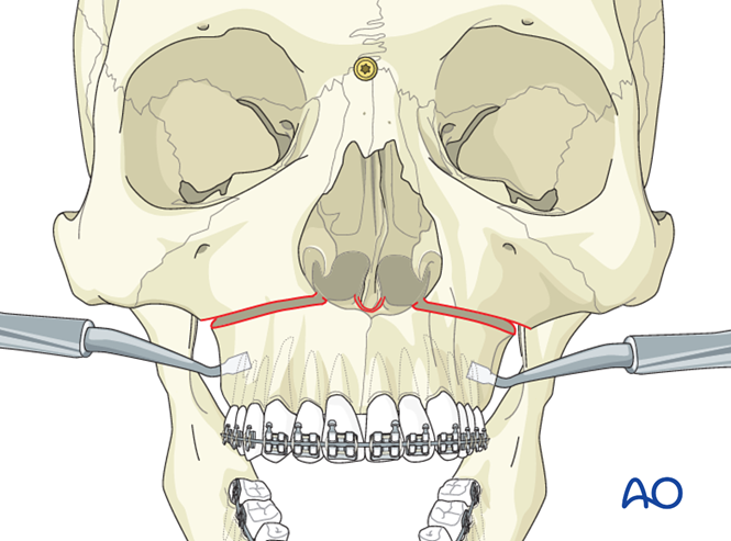 Le Fort I osteotomy for Maxillary prognathism