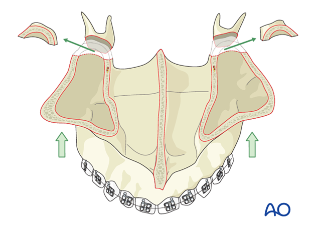 Le Fort I osteotomy for Maxillary prognathism
