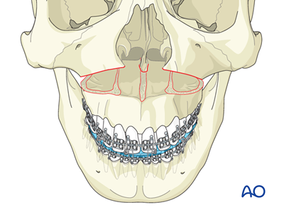 Le Fort I osteotomy for Maxillary retrognathism