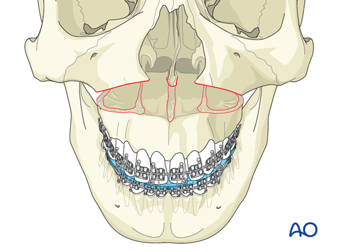 Le Fort I osteotomy for Maxillary prognathism
