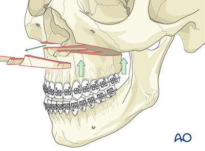 Le Fort I osteotomy for Maxillary prognathism