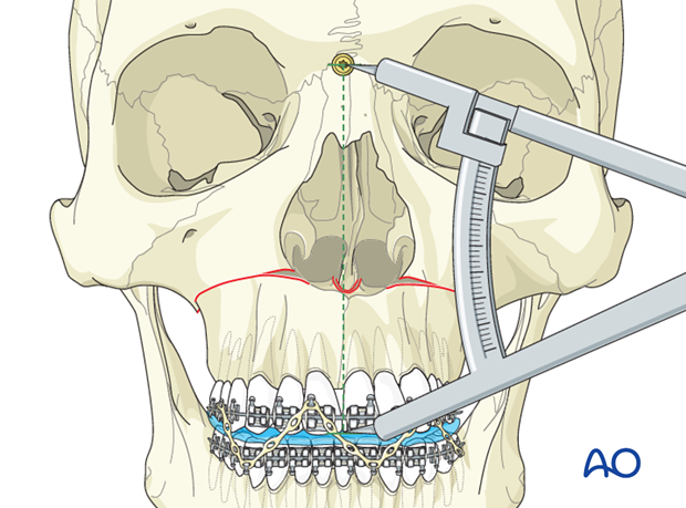 Le Fort I osteotomy for Maxillary retrognathism