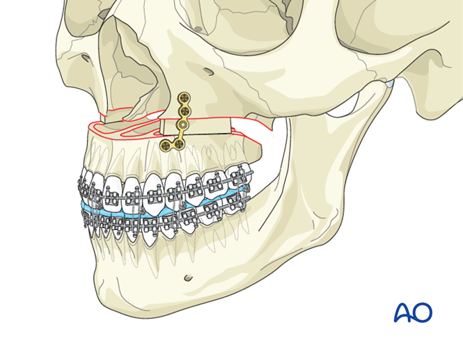 Le Fort I osteotomy for Maxillary retrognathism