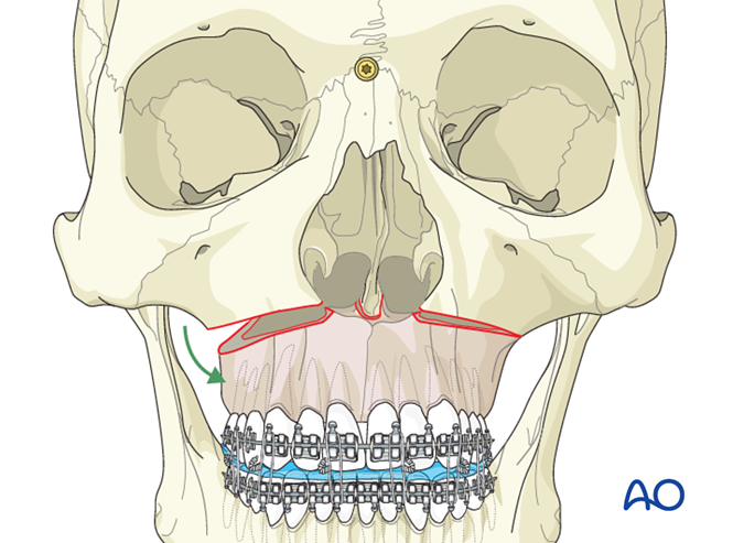 Le Fort I osteotomy for Maxillary prognathism