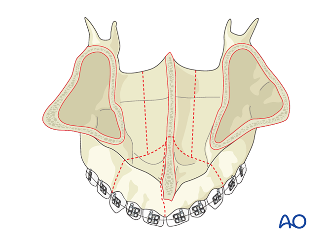 Le Fort I osteotomy for Maxillary prognathism
