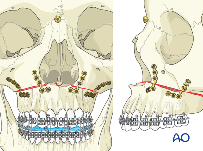 Le Fort I osteotomy for Maxillary retrognathism