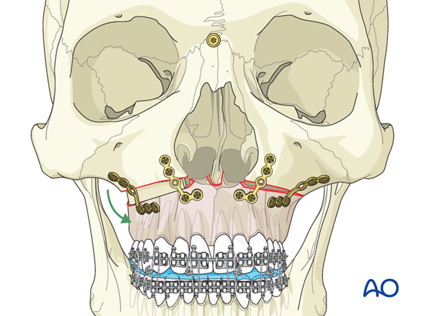 Rotational osteotomies including inverted L-osteotomy for Pruzansky III