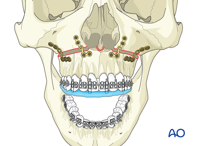 Le Fort I osteotomy for Maxillary prognathism