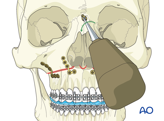 Le Fort I osteotomy for Maxillary prognathism