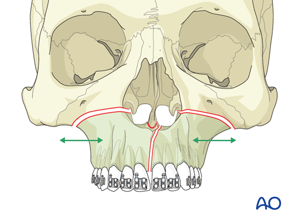 Surgically assisted rapid palatal expansion for Transverse hypoplasia ...
