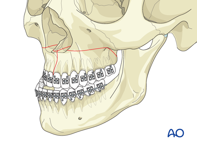 Surgically assisted rapid palatal expansion for Transverse hypoplasia ...