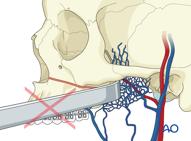 Surgically assisted rapid palatal expansion for Transverse hypoplasia ...