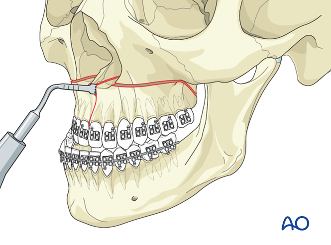 Surgically assisted rapid palatal expansion for Transverse hypoplasia ...