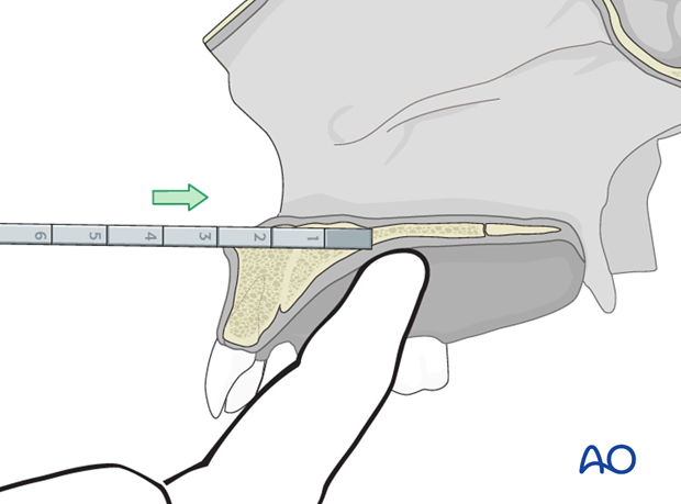 Surgically assisted rapid palatal expansion for Transverse hypoplasia ...