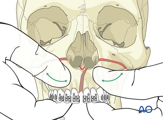 Surgically assisted rapid palatal expansion for Transverse hypoplasia ...