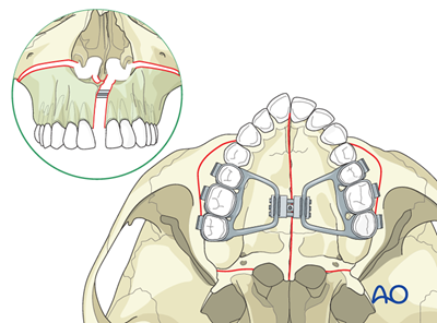 Surgically assisted rapid palatal expansion for Transverse hypoplasia ...