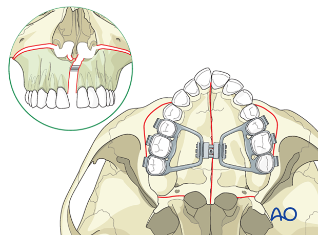 Surgically assisted rapid palatal expansion for Transverse hypoplasia ...