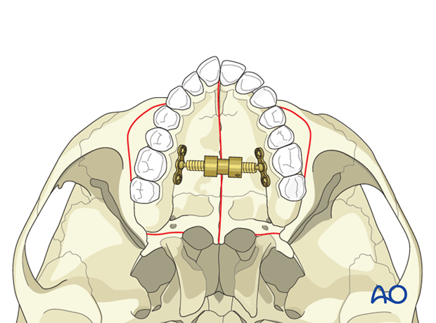 Surgically assisted rapid palatal expansion for Transverse hypoplasia ...