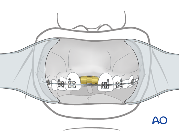 Surgically assisted rapid palatal expansion for Transverse hypoplasia ...