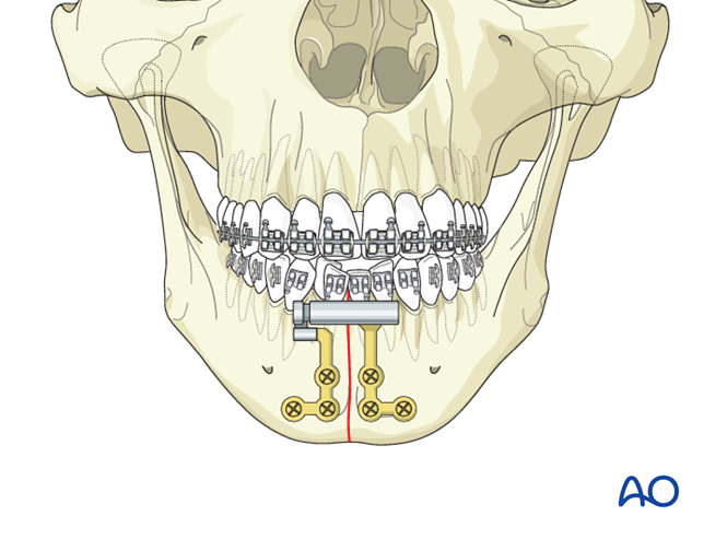 Surgically assisted rapid mandibular expansion for Transverse ...