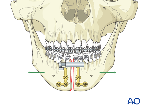 Surgically assisted rapid mandibular expansion for Transverse ...