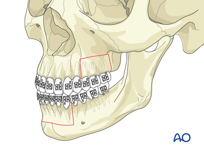 Subapical (block) osteotomy for Mandibular alveolar protrusion