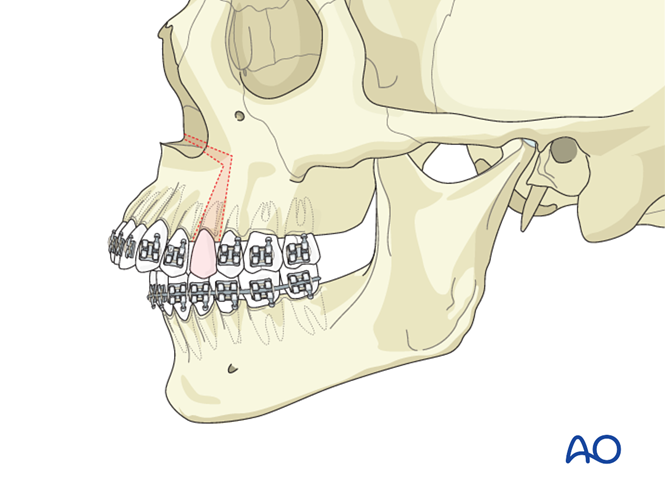 Subapical (block) osteotomy for Maxillary alveolar protrusion