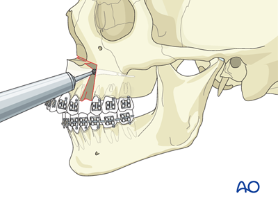 Subapical (block) osteotomy for Mandibular alveolar protrusion