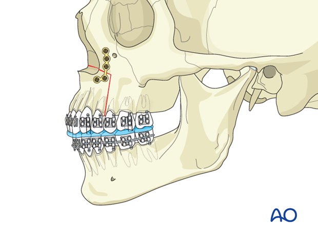 Subapical (block) osteotomy for Mandibular alveolar retrusion