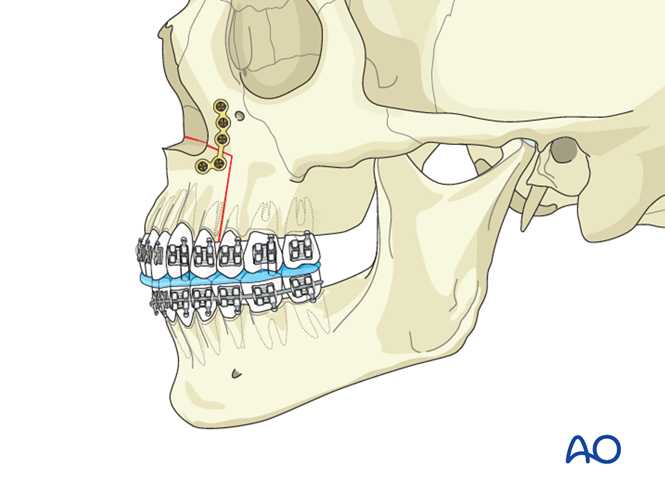 Subapical (block) osteotomy for Mandibular alveolar protrusion