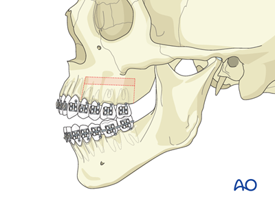 Subapical (block) osteotomy for Mandibular alveolar retrusion