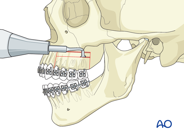 Subapical (block) osteotomy for Mandibular alveolar protrusion