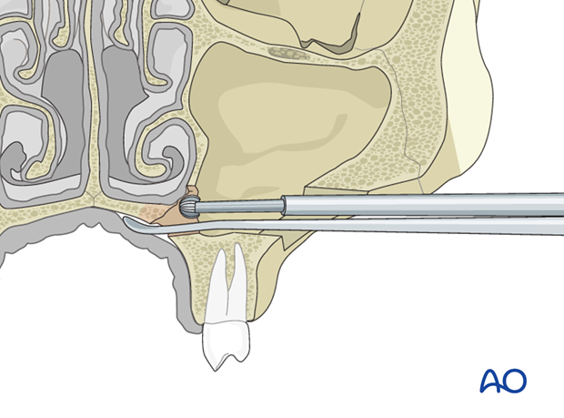 Subapical (block) osteotomy for Mandibular alveolar protrusion