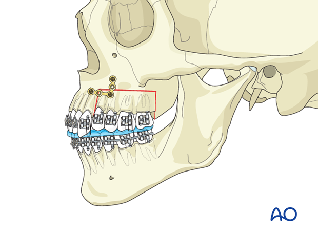 Subapical (block) osteotomy for Mandibular alveolar protrusion