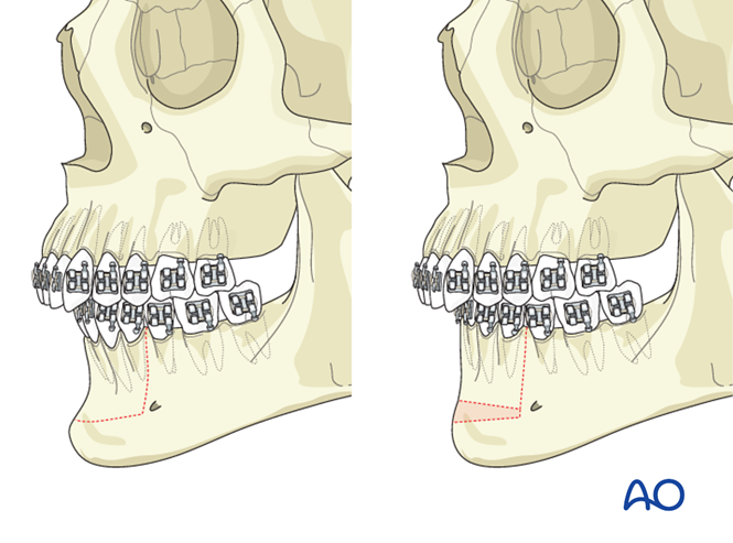 Subapical (block) osteotomy for Mandibular alveolar protrusion