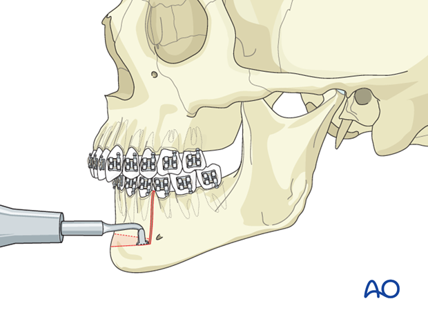 Subapical (block) osteotomy for Mandibular alveolar retrusion