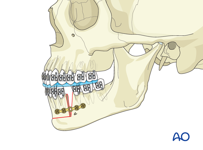 Subapical (block) osteotomy for Mandibular alveolar protrusion