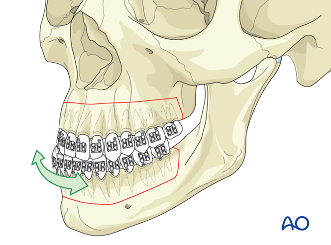 Subapical (block) osteotomy for Mandibular alveolar retrusion