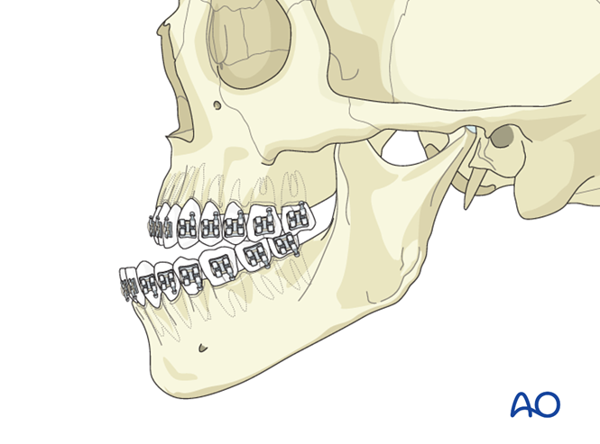 Two jaw surgery