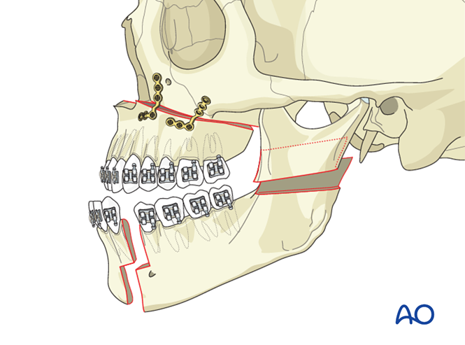 Two jaw surgery