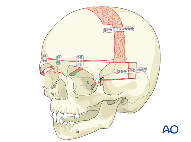 Bilateral orbital advancement for Bilateral coronal synostosis