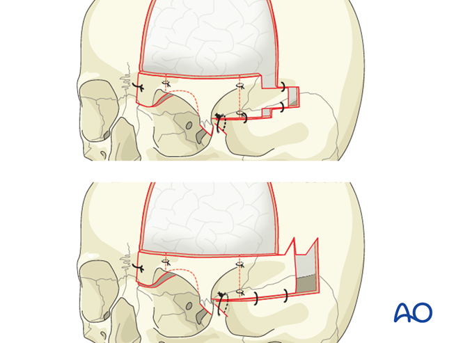 Unilateral orbital advancement for Unilateral coronal synostosis