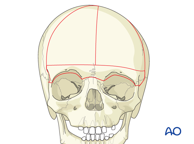 Bilateral orbital advancement for Unilateral coronal synostosis