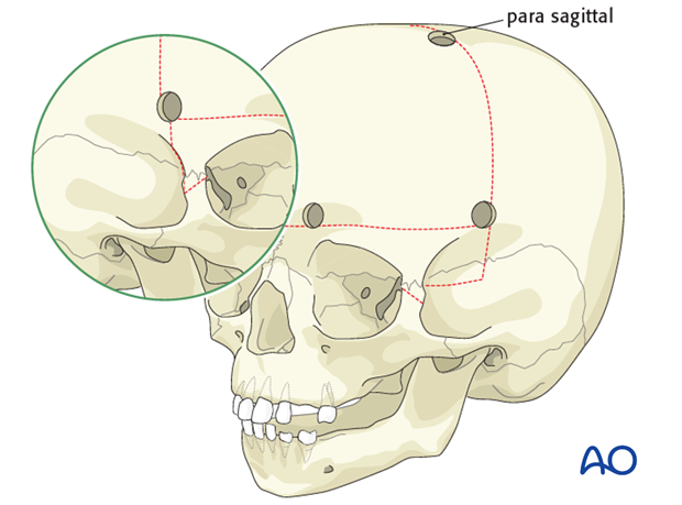 Bilateral orbital advancement for Unilateral coronal synostosis