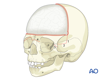 Bilateral orbital advancement for Unilateral coronal synostosis