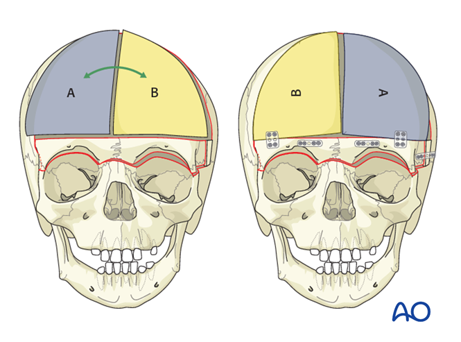 Bilateral orbital advancement for Unilateral coronal synostosis
